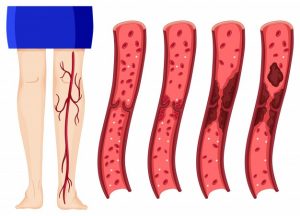 Trombosis venosa profunda: Todo lo que necesitas saber